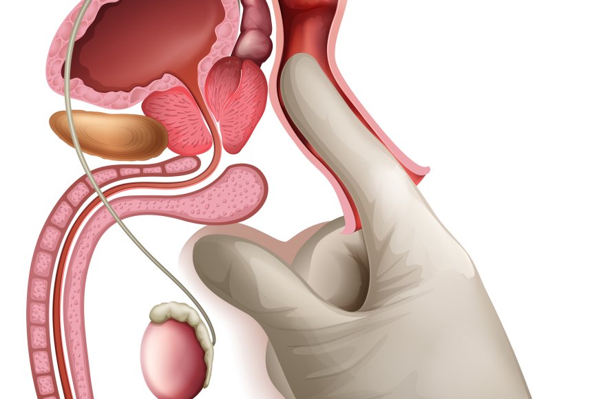 Varikokela: Uzroci, Simptomi i Liječenje – Sve što Treba da Znate ...